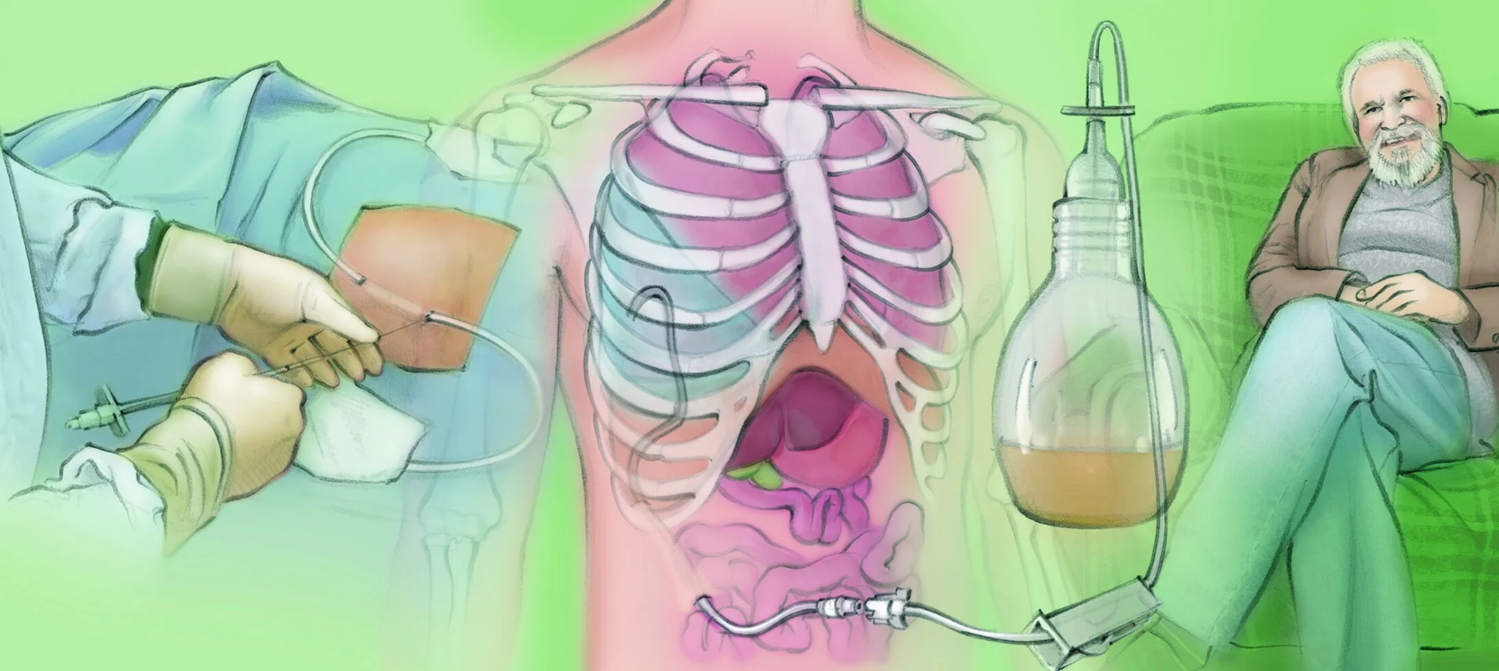 Tunneled Drainage Catheter — The Interventional Initiative