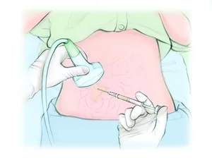 Abscess Drain — The Interventional Initiative