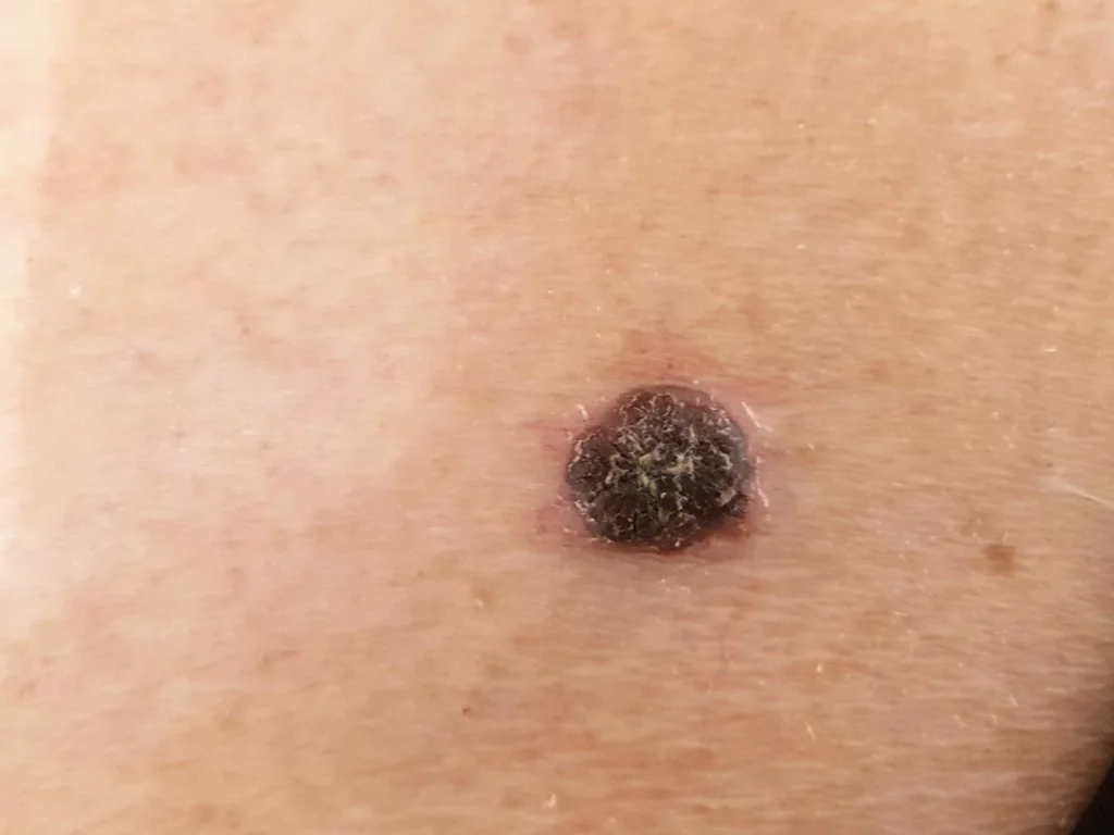 Prickar, vårtor, fläckar & knölar — Laser & Dermatology
