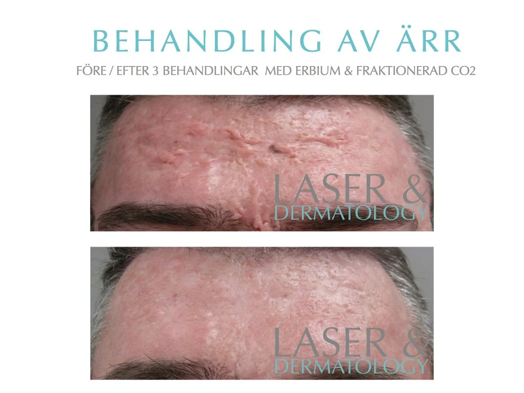 Laserbehandling av ärr i Malmö. — Laser & Dermatology