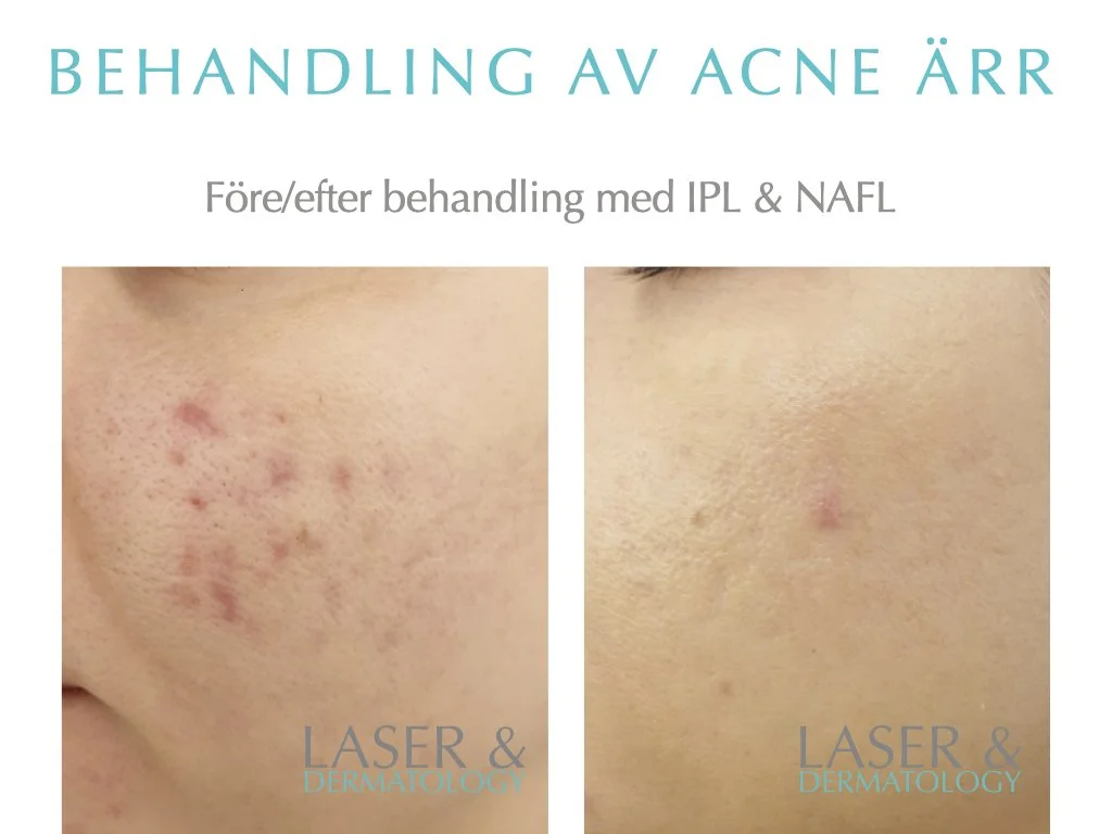 Laserbehandling av ärr i Malmö. — Laser & Dermatology