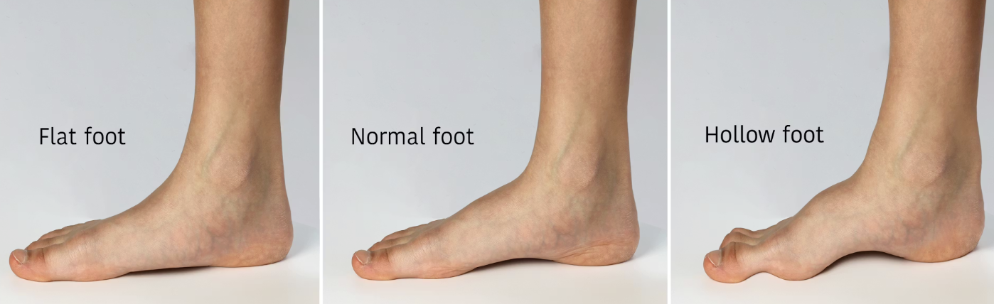 Should You Get Orthotics for Flat Feet? Here’s When They Actually Help ...