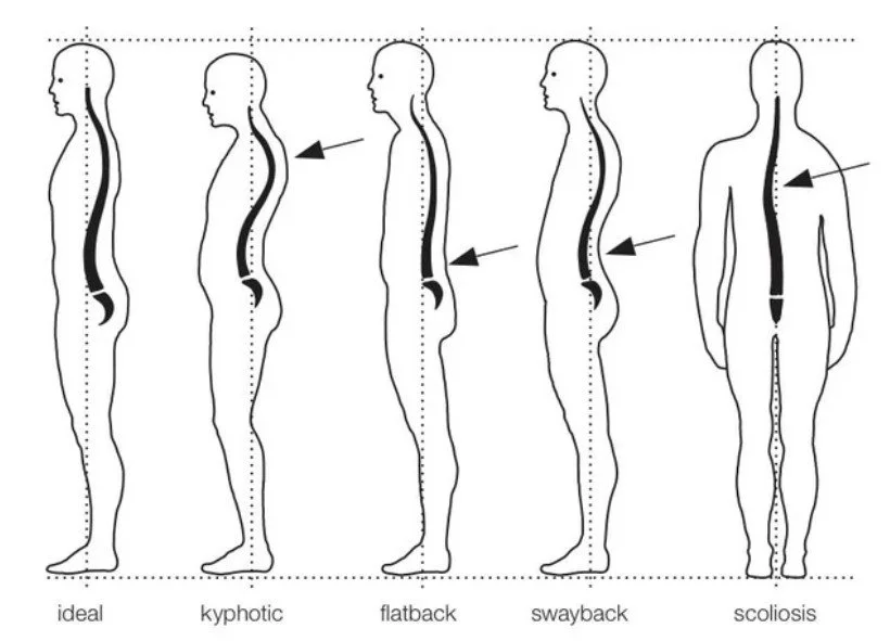 What Is Your Posture Type?