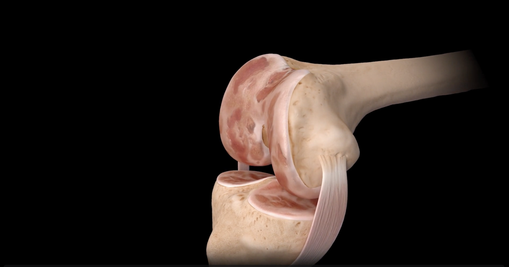 Knee Osteoarthritis — Jonathan Koscso, MD