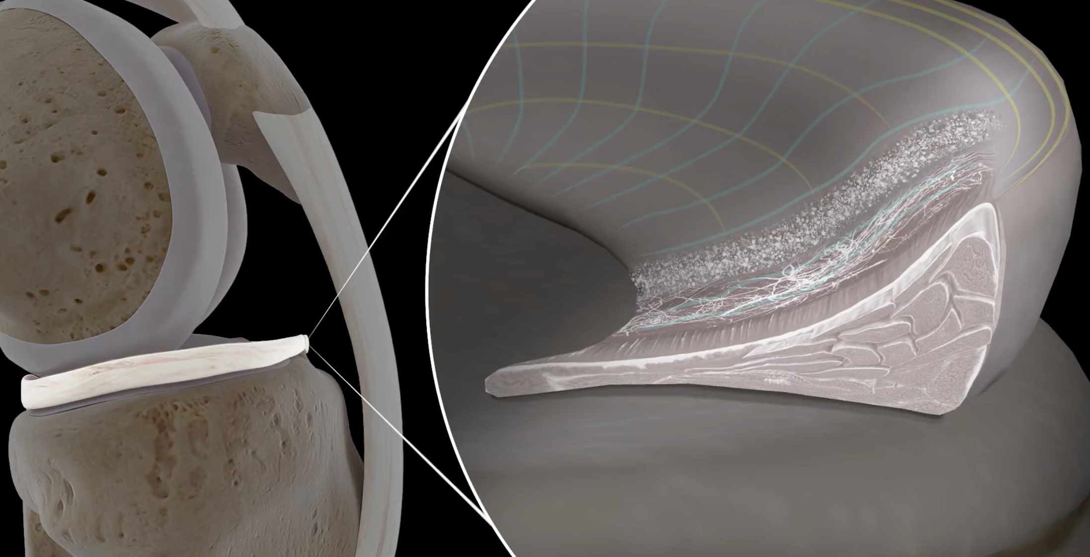 Meniscus Tear — Jonathan Koscso, MD