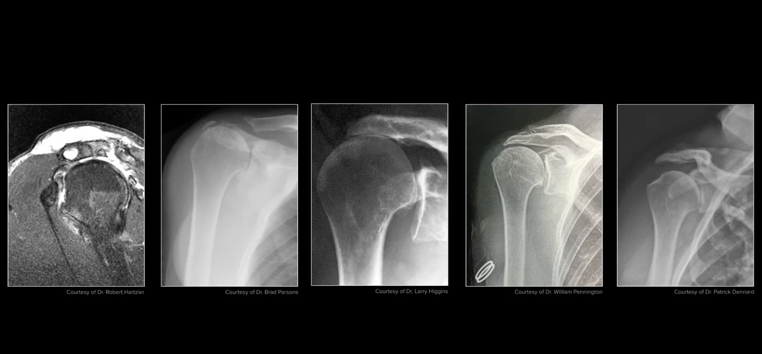 Cuff Tear Arthropathy — Jonathan Koscso, MD