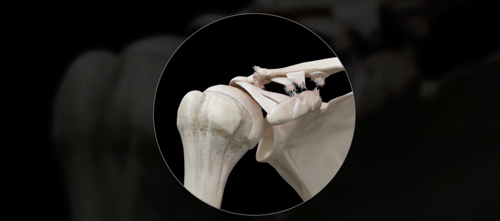AC Joint Injury — Jonathan Koscso, MD