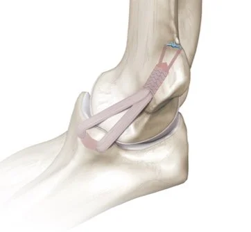 Ulnar Collateral Ligament Tear — Jonathan Koscso, MD