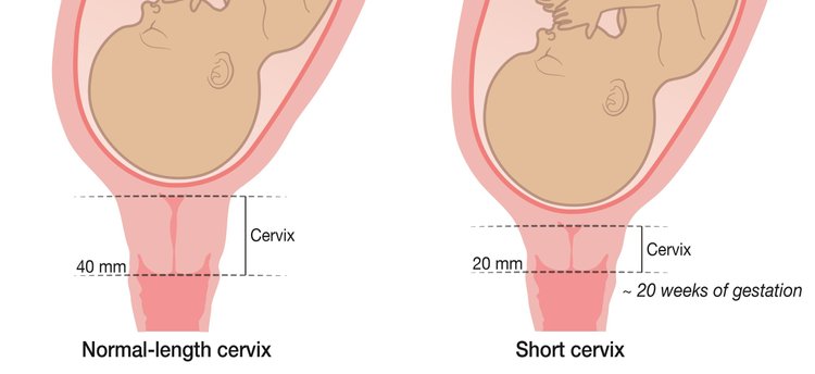Short Cervix — High Risk Pregnancy Information