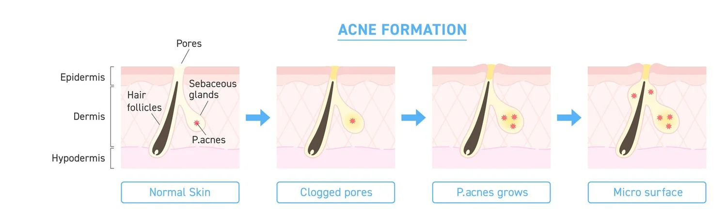 How is acne formed? — ARC WELLNESS