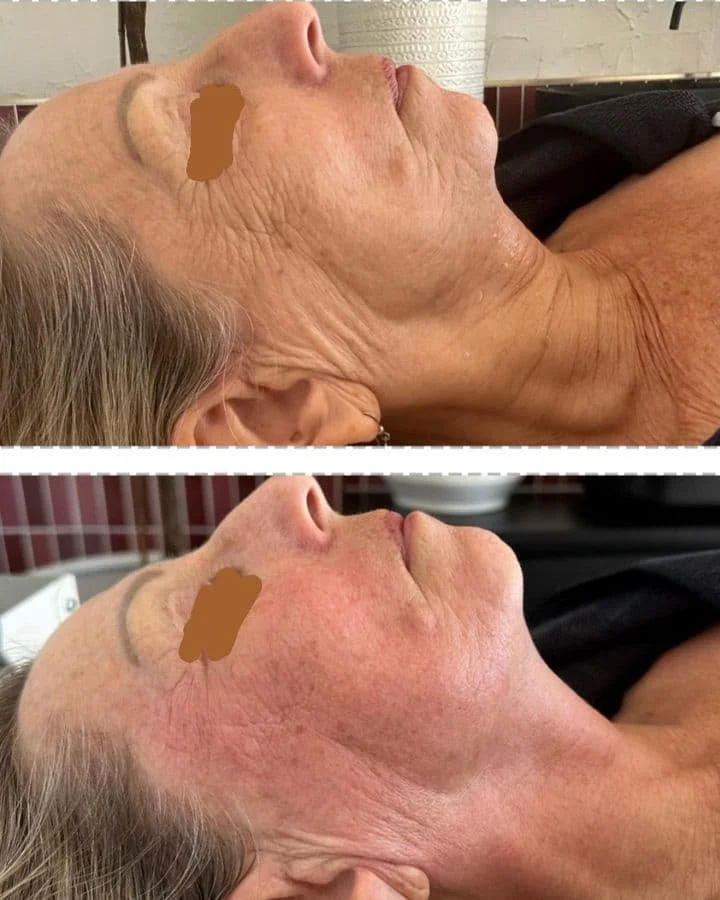 Are There Any Side Effects To RF Skin Tightening Treatments? — Sculpt ...