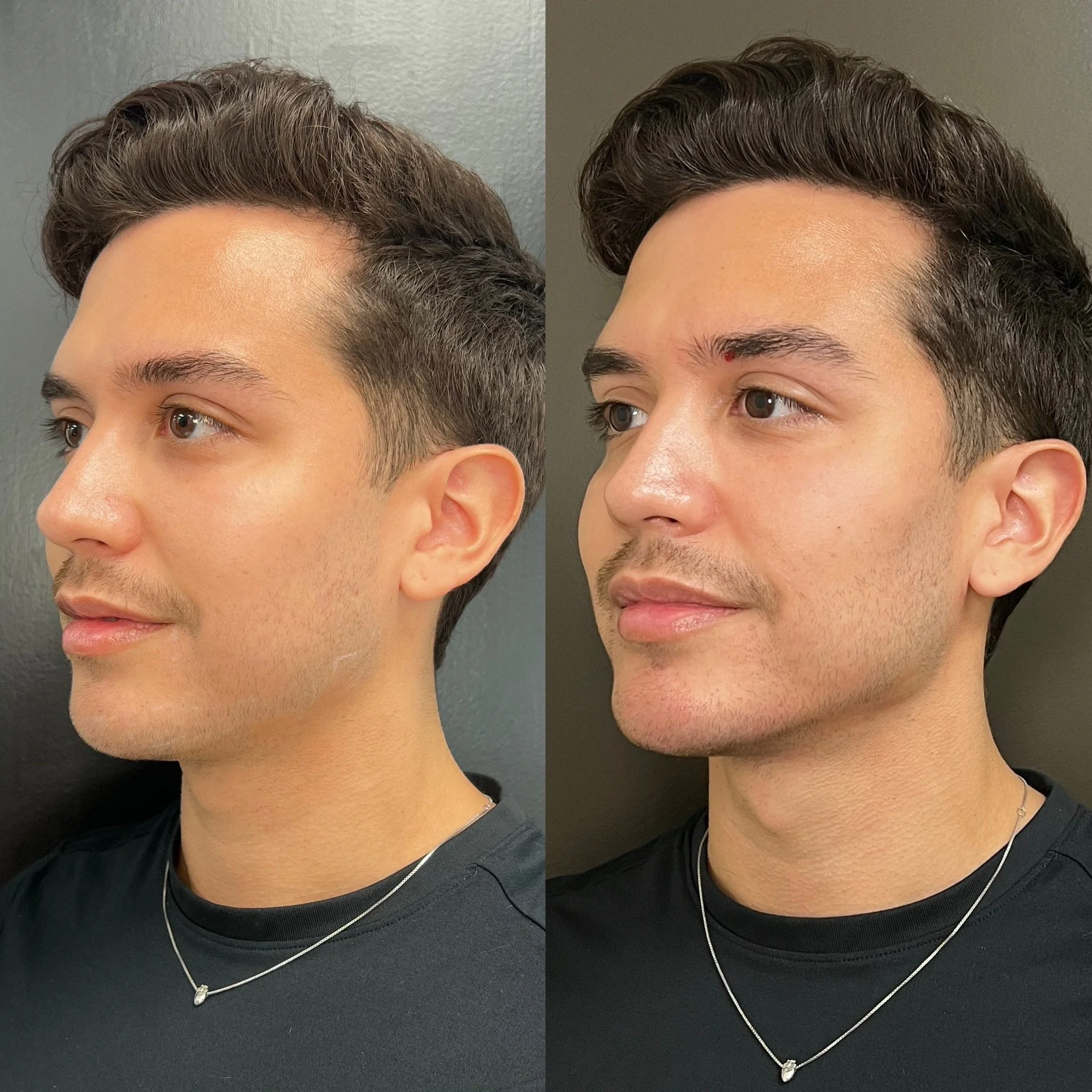 Botox Austin TX — Texas Laser & Aesthetics Med Spa