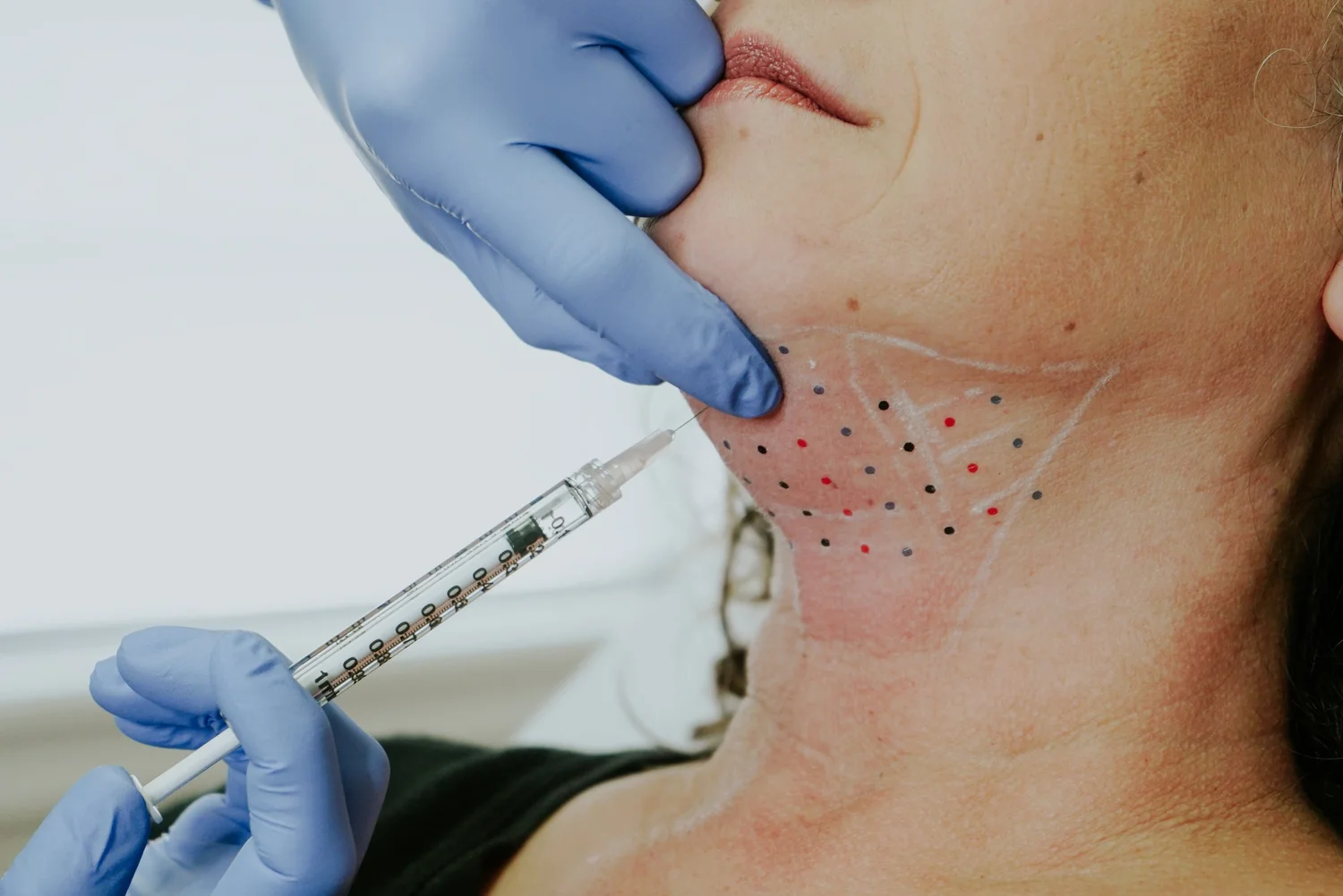 Kybella — Texas Laser & Aesthetics Med Spa