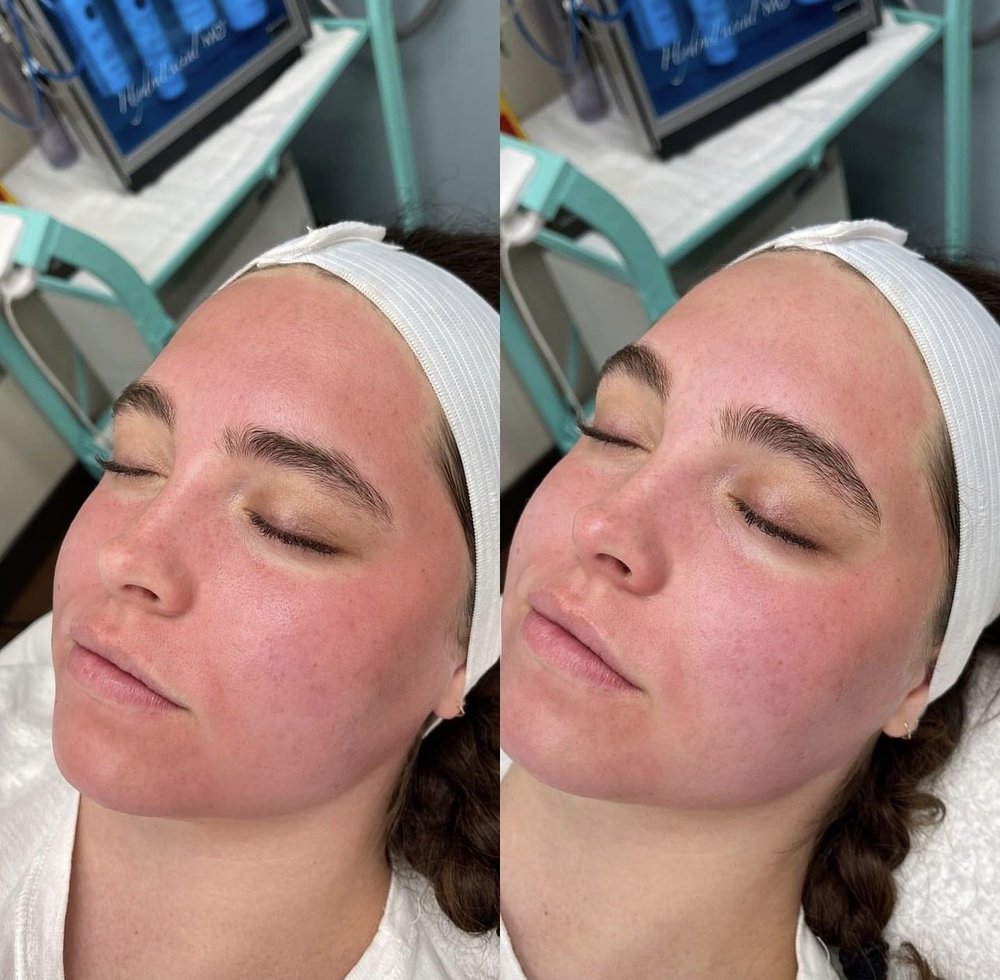 Scarlet RF Microneedling in Utah | Ramirez Dermatology