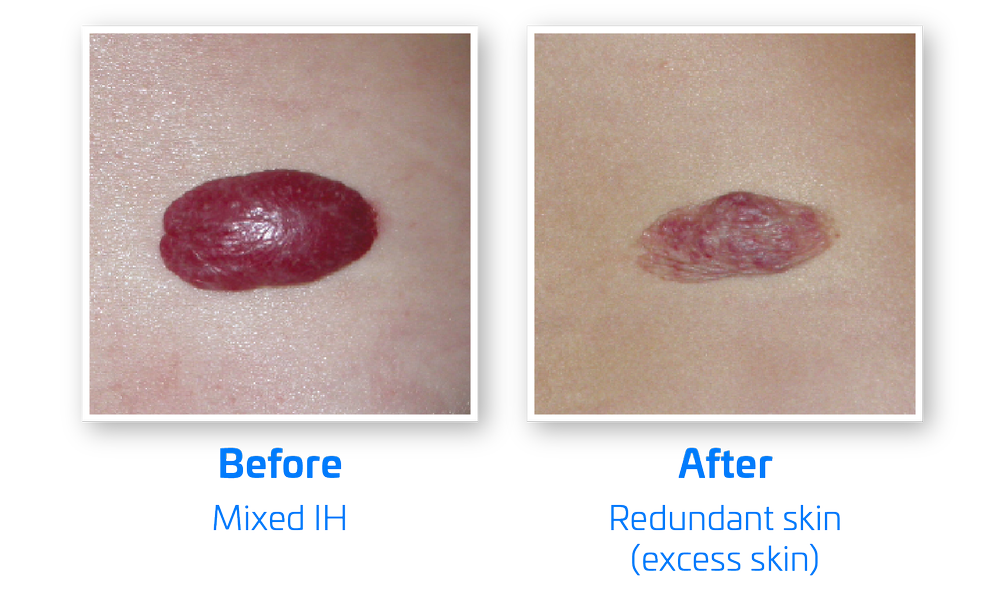 Arkayli Biopharma — Infantile Hemangioma