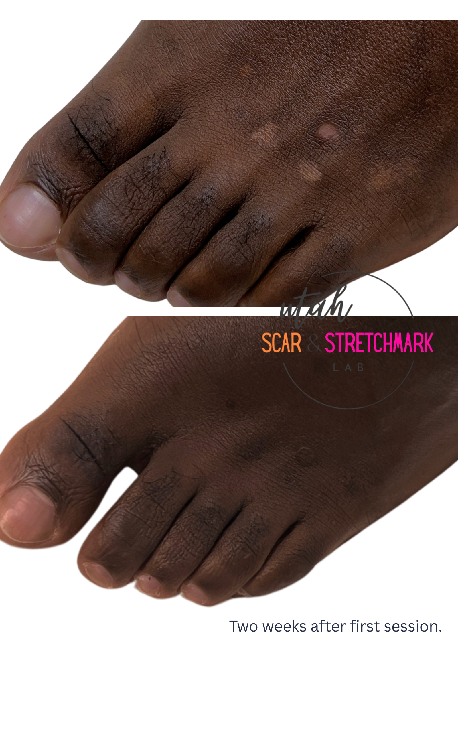 Camouflage Scar and Stretch Mark Tattoo. Scars, tummy tuck, surgical ...