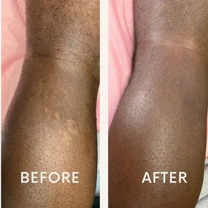 Camouflage Scar and Stretch Mark Tattoo. Scars, tummy tuck, surgical ...