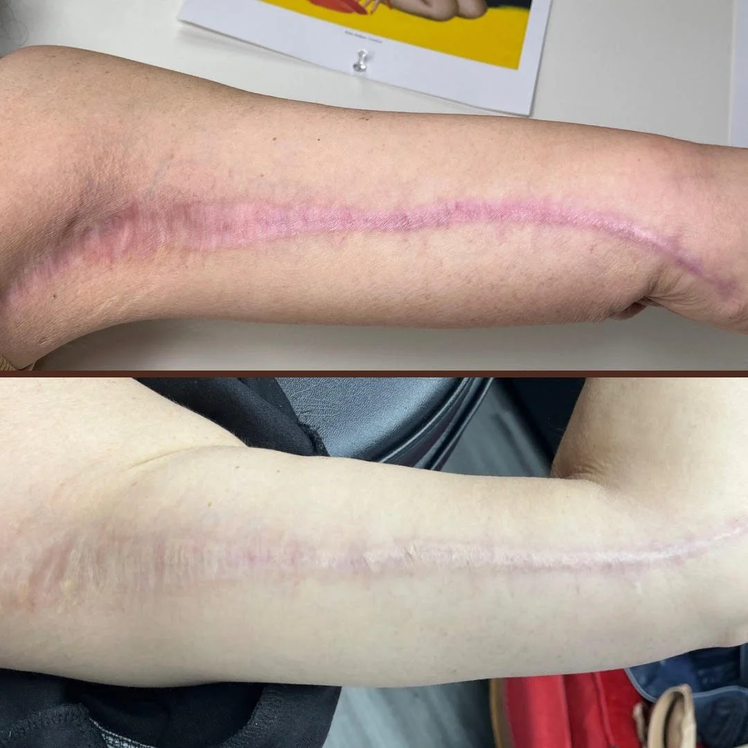 Camouflage Scar and Stretch Mark Tattoo. Scars, tummy tuck, surgical ...