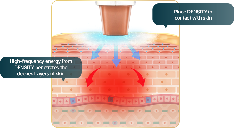 Density RF System | Skin Tightening & Collagen Remodeling | PureenMD ...