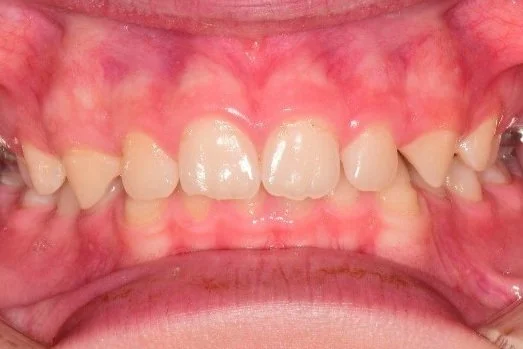 What are Turbo Bites and How Do They Work? — Cook Orthodontics of Dublin