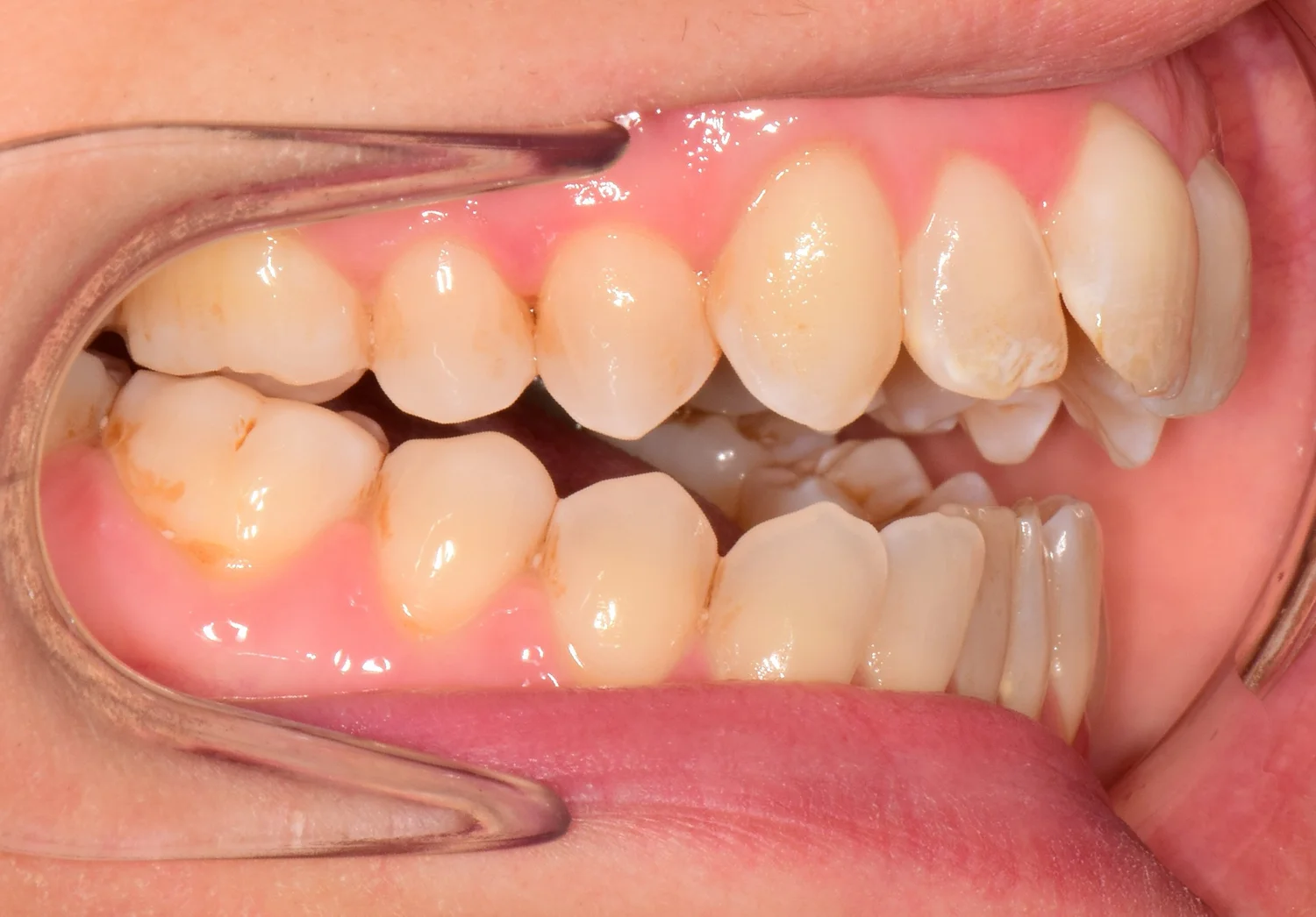 What are Tongue Tamers and How Do They Work? — Cook Orthodontics of Dublin