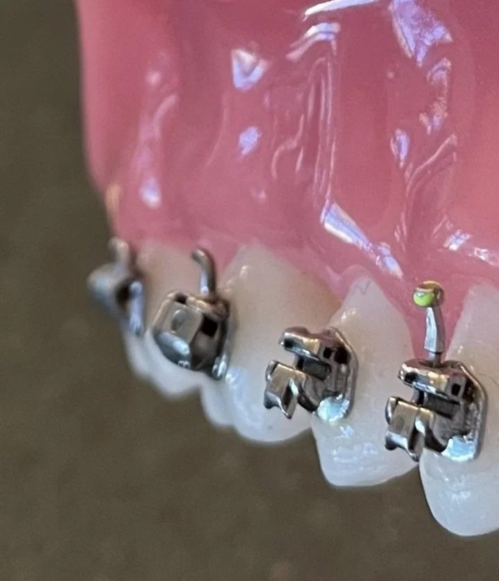 Standard Braces vs Damon Braces and How Braces Have Changed for the ...