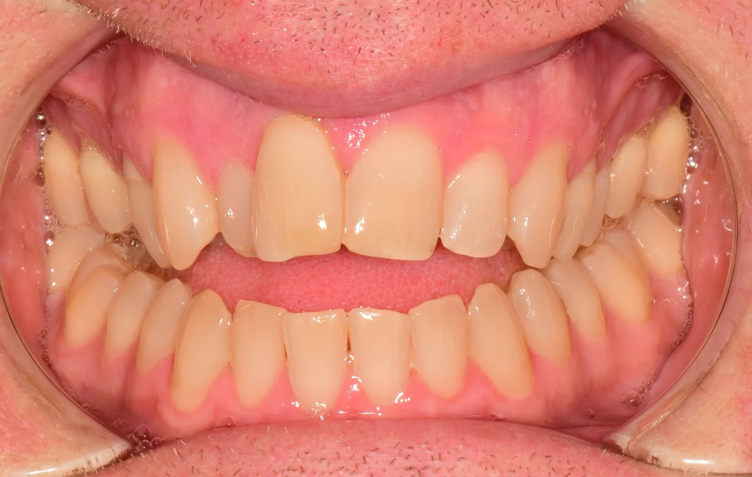 What are Tongue Tamers and How Do They Work? — Cook Orthodontics of Dublin