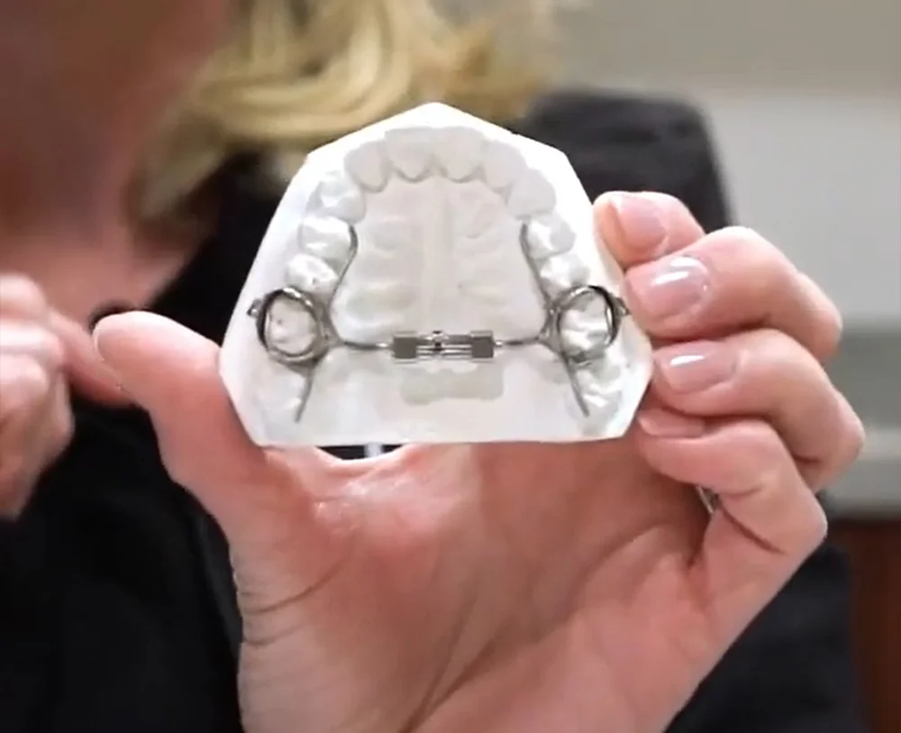 What are Lower Expanders and How do They Work? — Cook Orthodontics of ...
