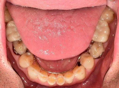 What are Turbo Bites and How Do They Work? — Cook Orthodontics of Dublin