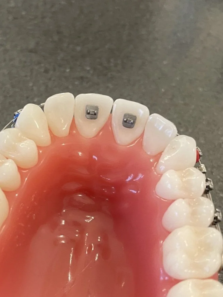 What are Tongue Tamers and How Do They Work? — Cook Orthodontics of Dublin