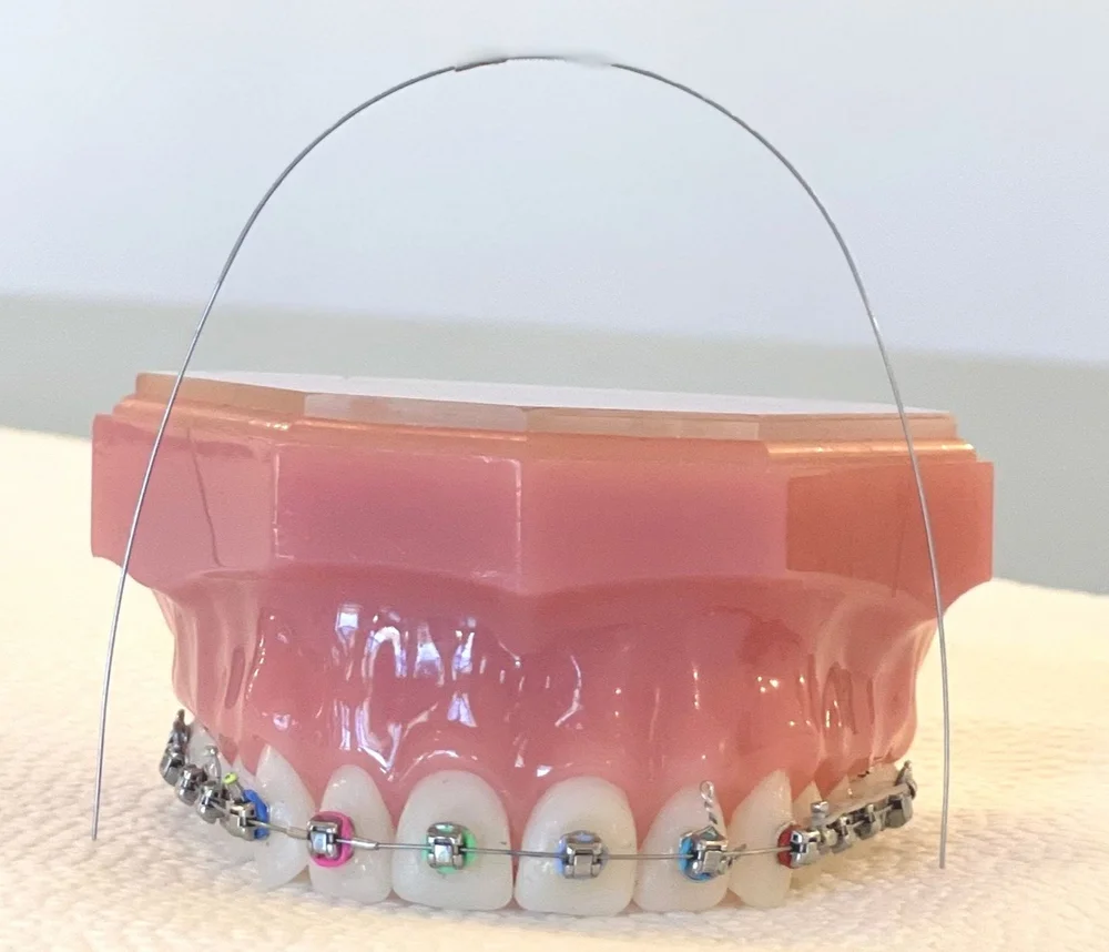 Standard Braces vs Damon Braces and How Braces Have Changed for the ...