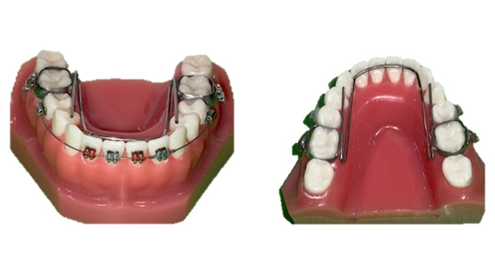 What are Lower Expanders and How do They Work? — Cook Orthodontics of ...