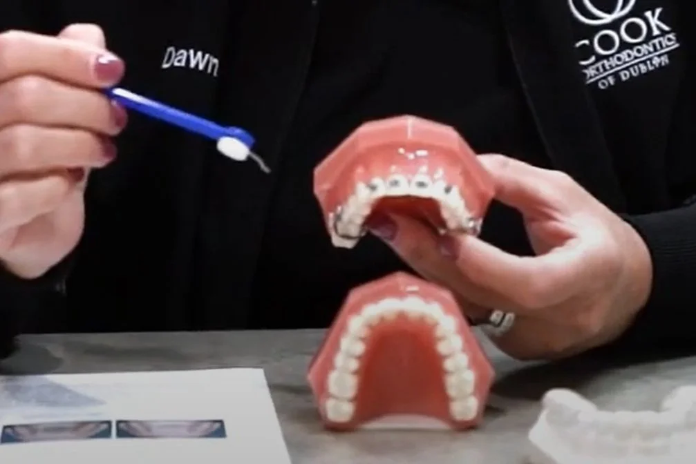 What are Palate Expanders and How Do They Work? — Cook Orthodontics of Dublin