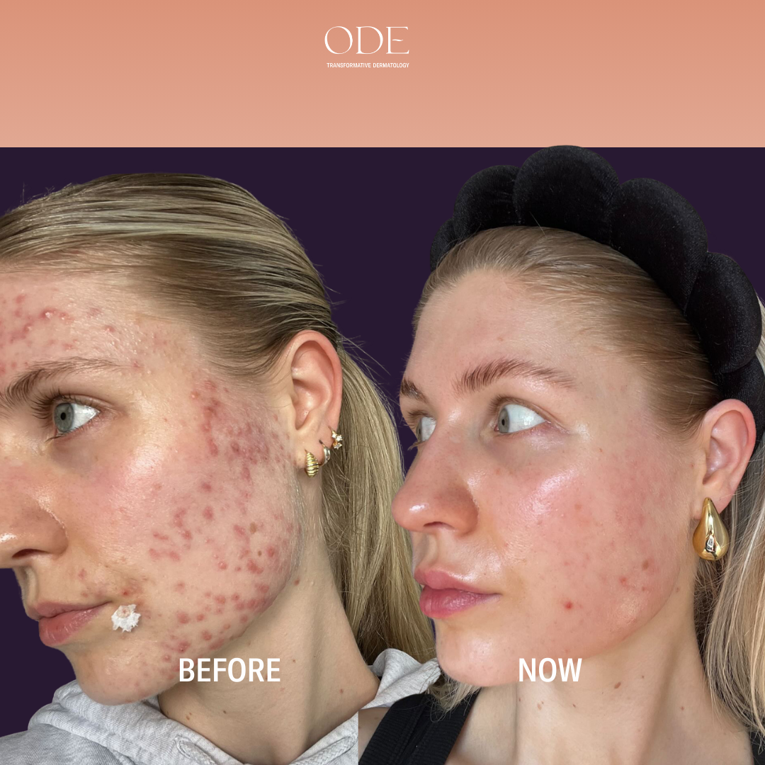 Acne Factsheet — ODE Dermatology