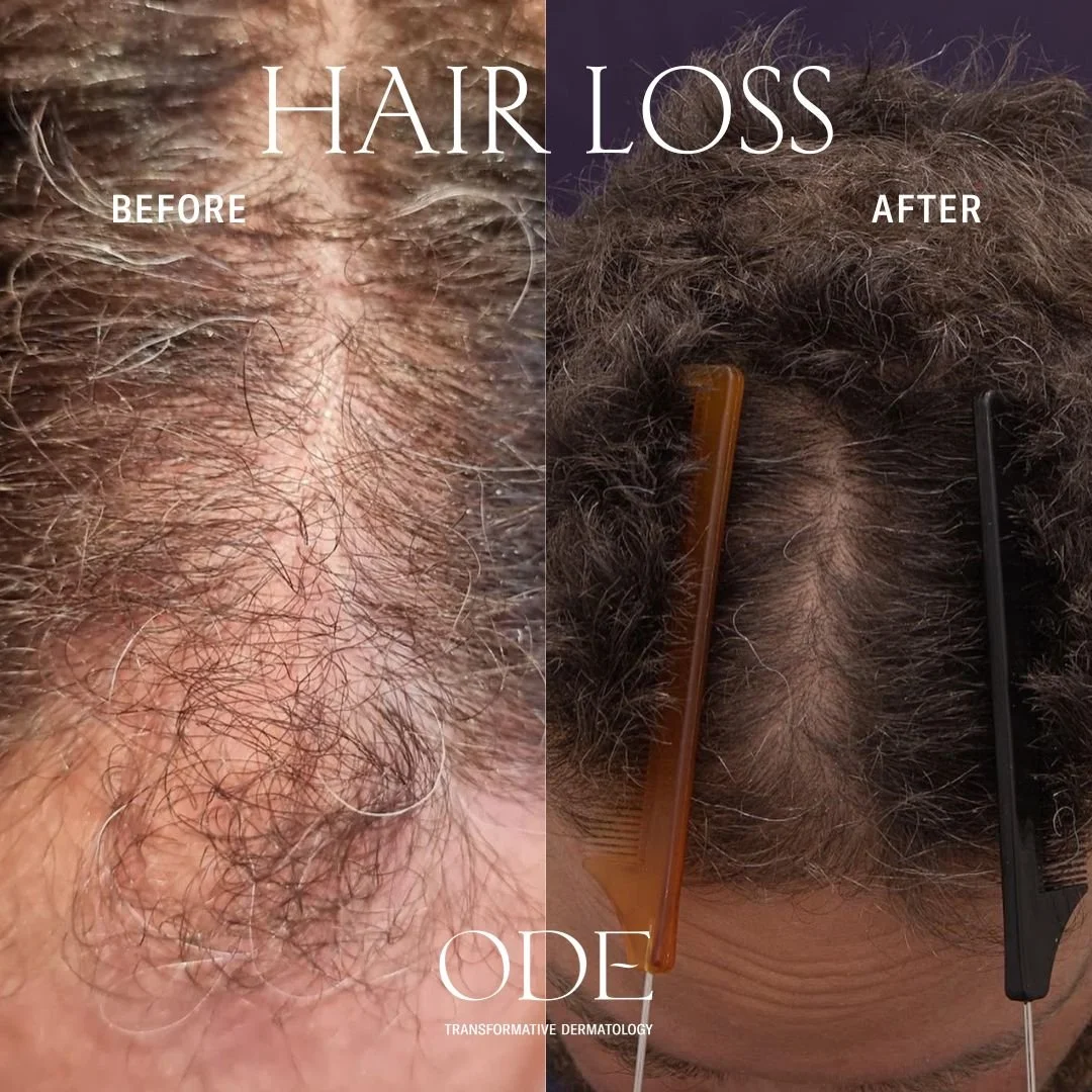 Male Pattern Balding — Ode Dermatology