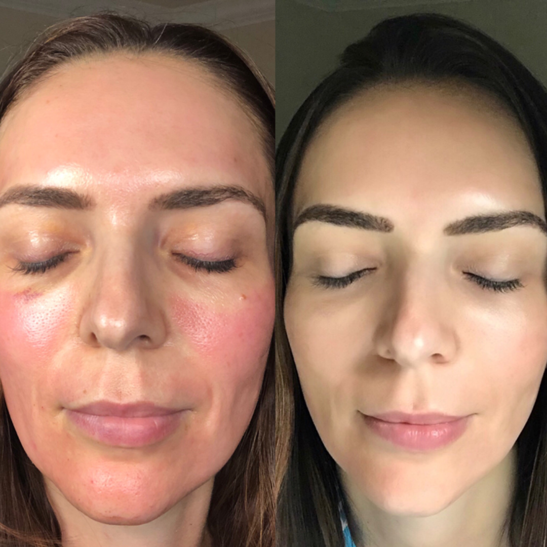 CO2 Lift Pro Carboxy Gel Treatment — Sweet Skin by Ivana