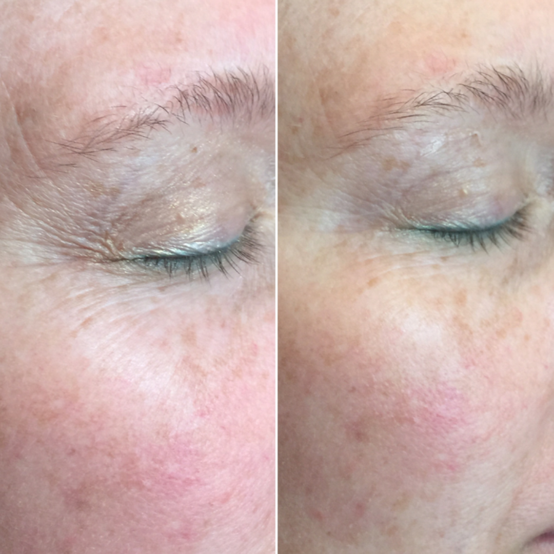 CO2 Lift Pro Carboxy Gel Treatment — Sweet Skin by Ivana