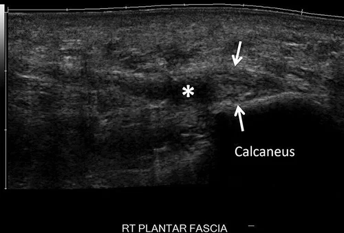 PRP and Tenex for Plantar Fasciitis — Treatment Options Beyond ...