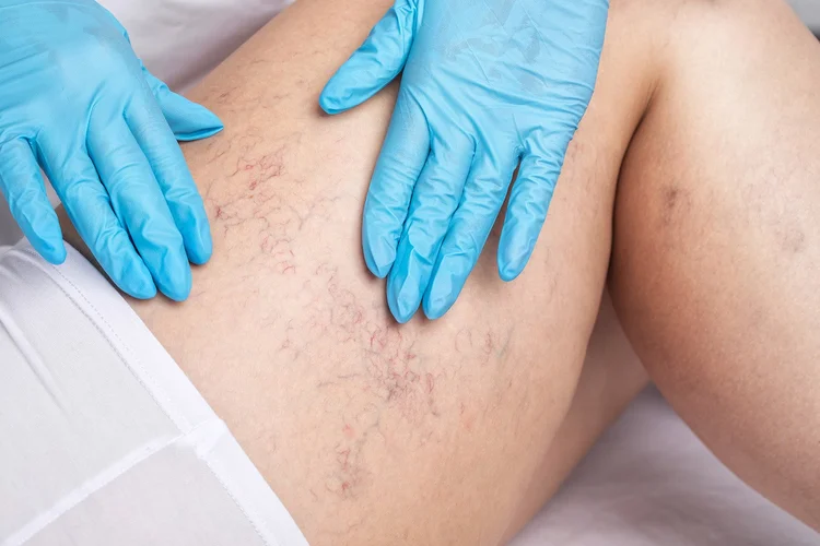 Sclerotherapy for 'Spider' Veins — Southern Vein & Cosmetic Centre | Dr ...