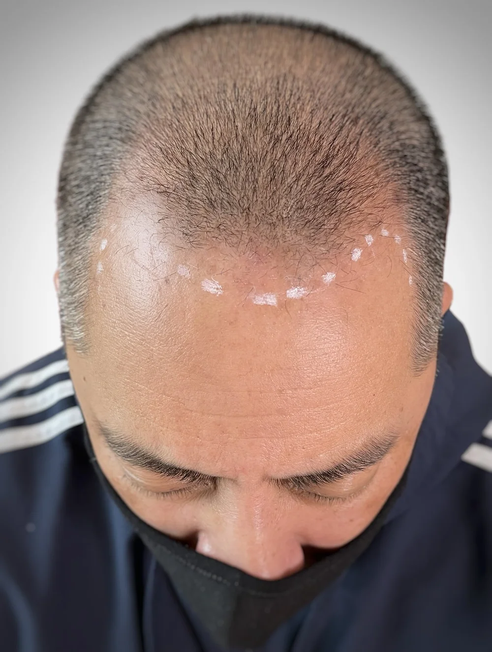INK HDZ Scalp Micropigmentation