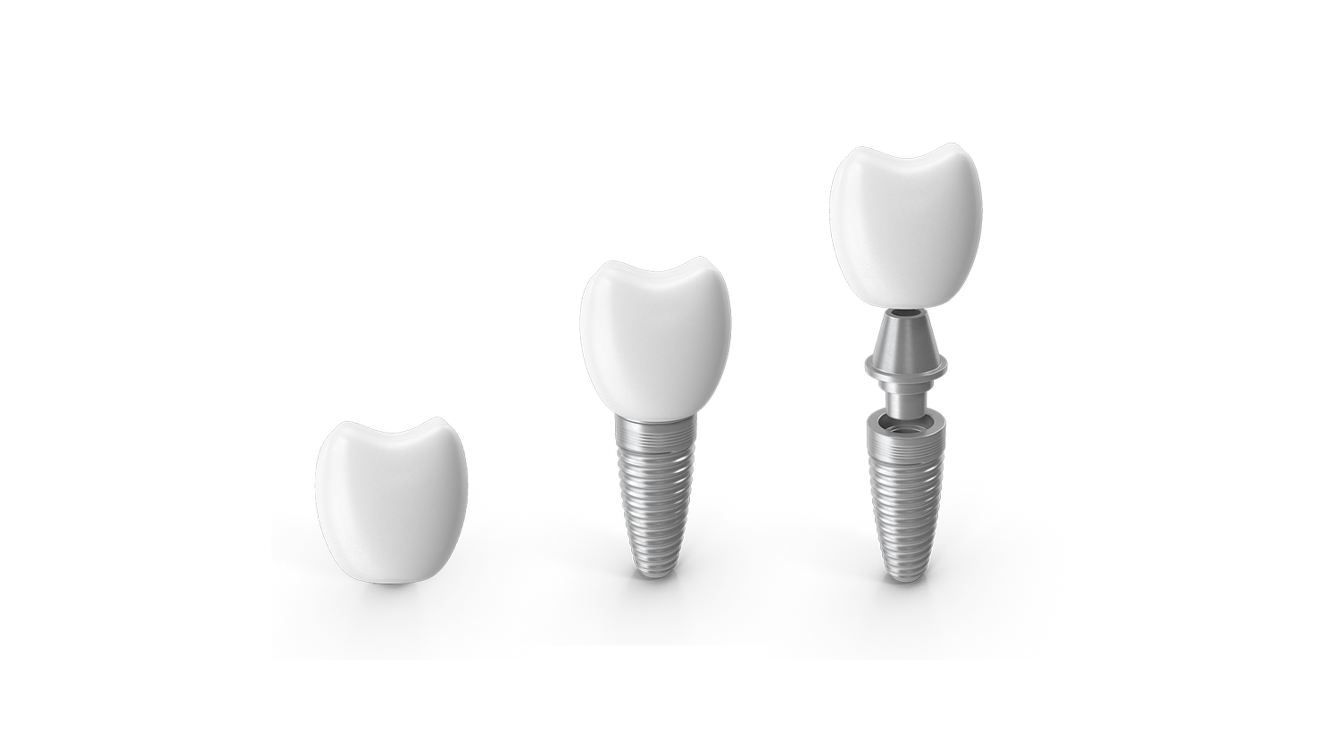 Single & multiple implants — Rock Solid Implants & Dentures