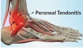 The Vital Role of the Peroneal Muscles in Foot Function