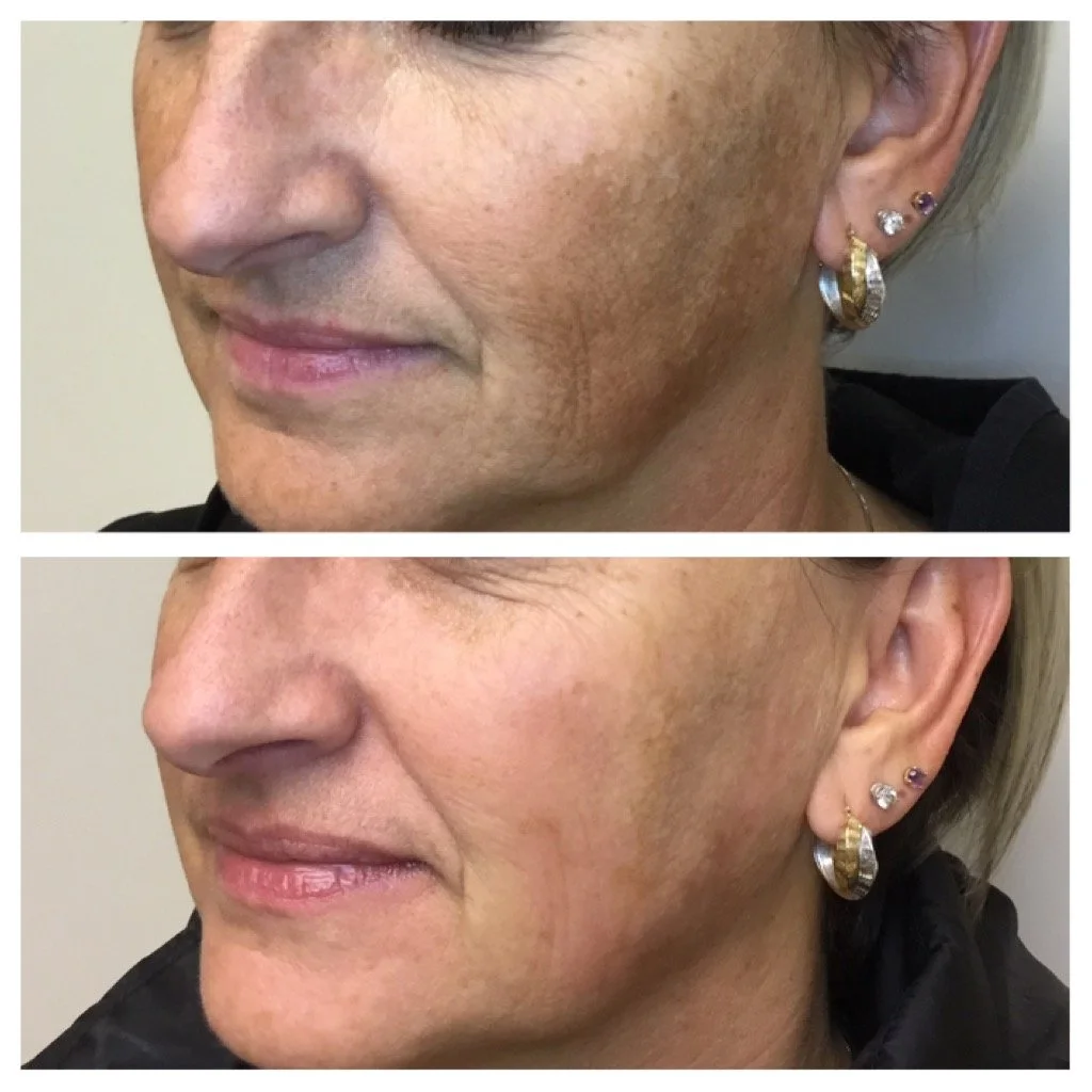 IPL Photorejuvenation — Coco Laser & Skin