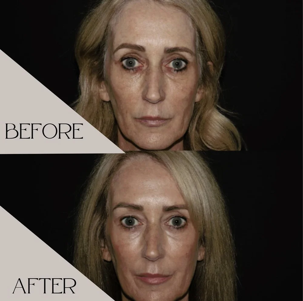 Co2 Fractional Resurfacing — Coco Laser & Skin