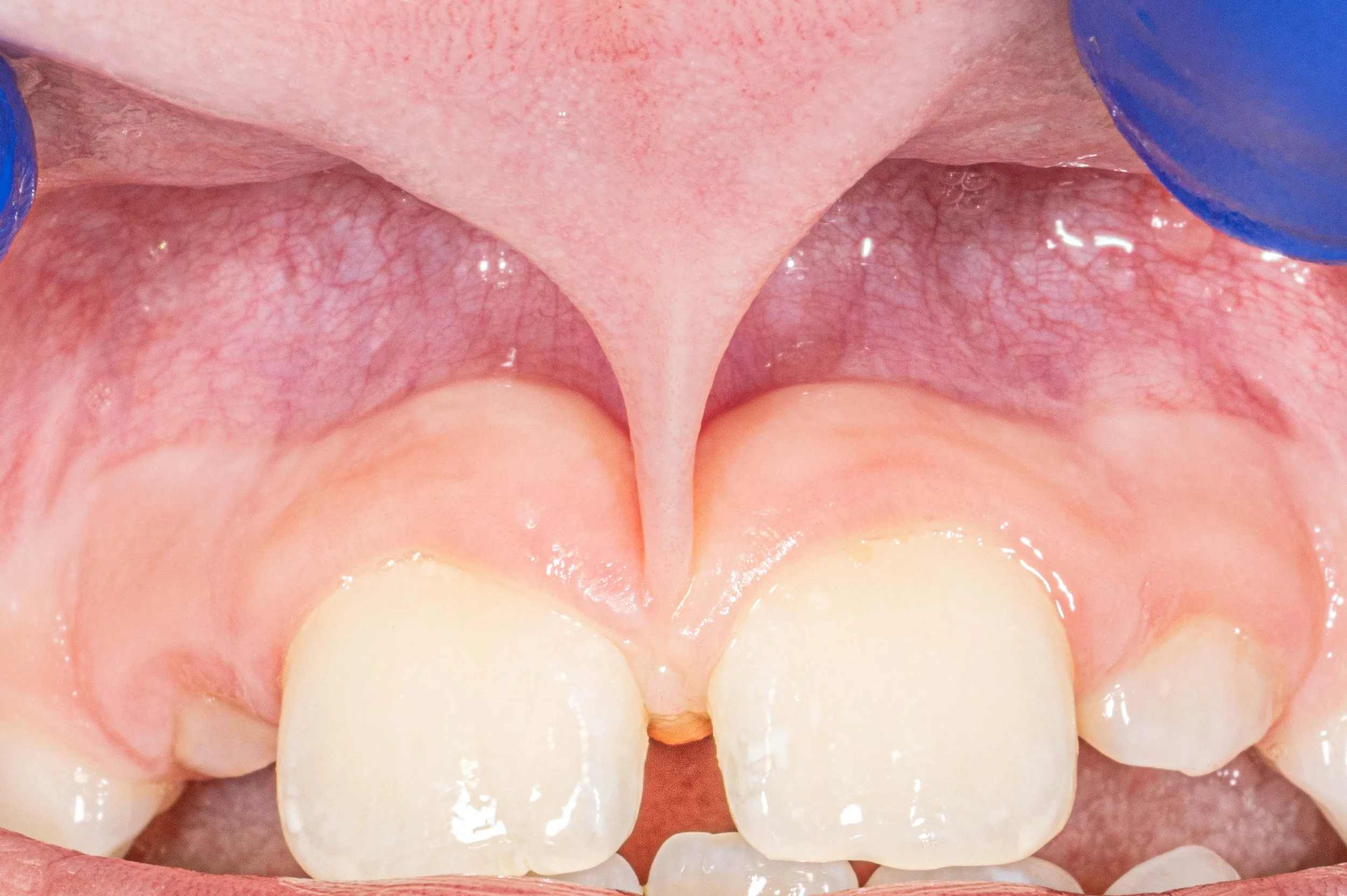 FRENECTOMY Michigan Implants And Periodontics FRENECTOMY Michigan Implants And Periodontics