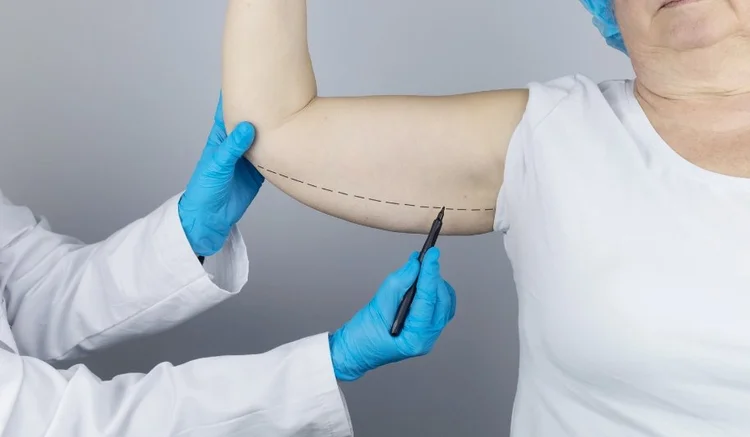 A Comprehensive Guide to Arm Lift Surgery in Thailand