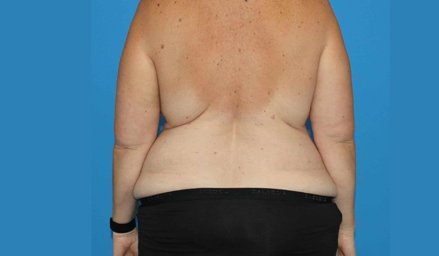 Bra Line Back Lift Surgery Before And After
