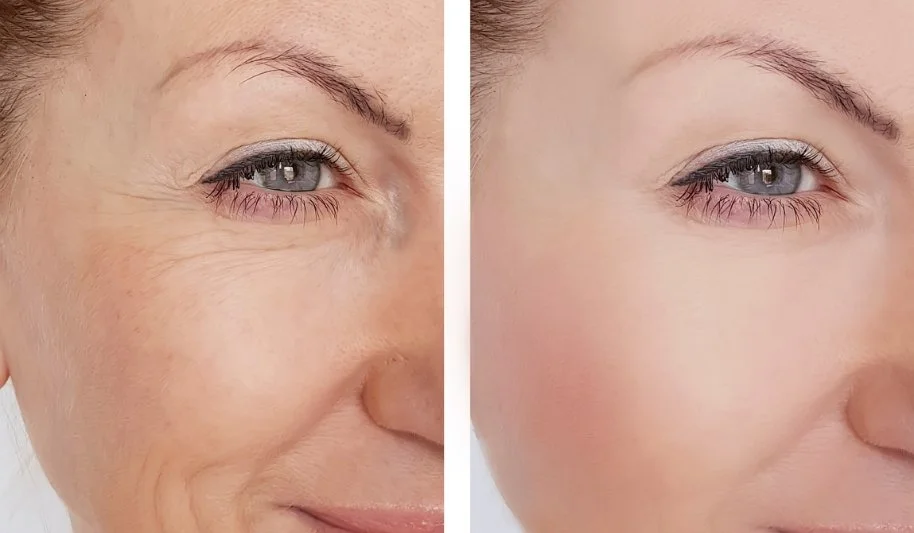 Brow Lift Botox Before And After | Top Injectors | Top Clinics in ...