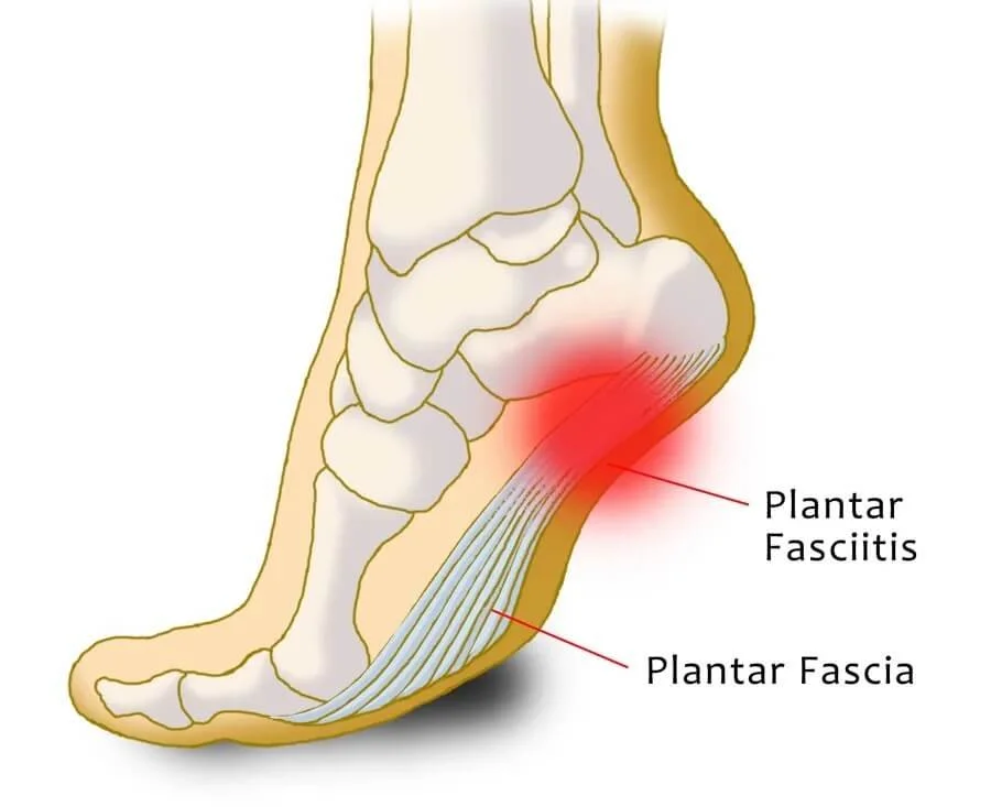 Plantar Fasciitus — Knight Foot and Ankle