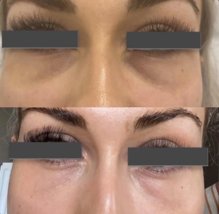 Tear Trough Treatment — Courtney Cassidy Aesthetics